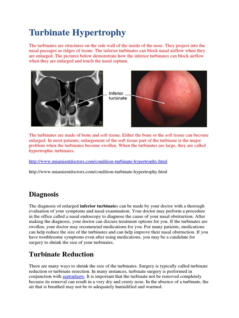 Turbinate Hypertrophy | PDF | Human Nose | Mucus