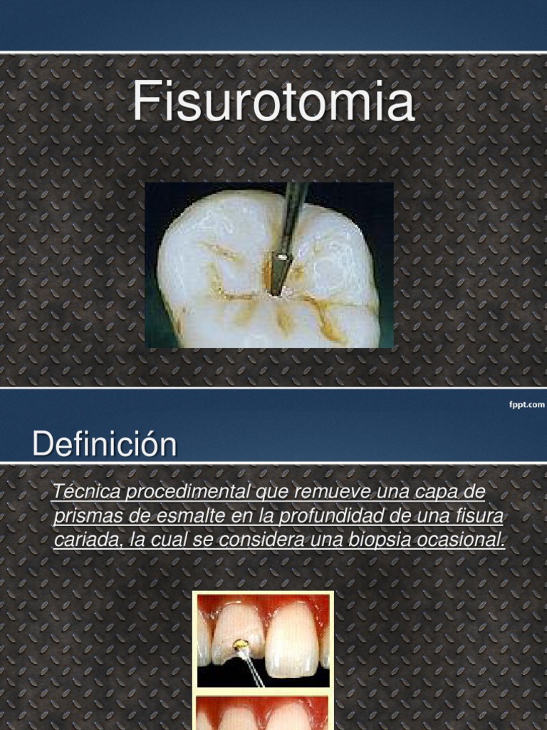 Fisurotomia | PDF