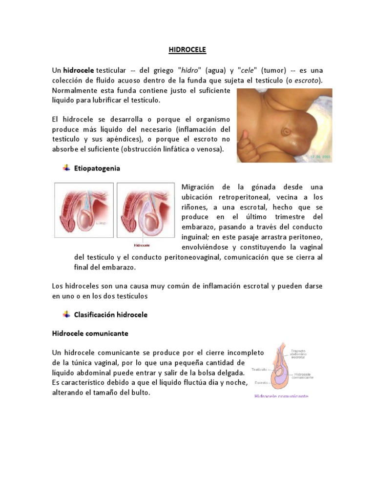 Hidrocele Word | PDF | Testículo | Especialidades Medicas