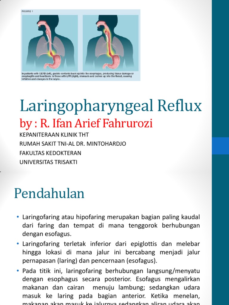 Refluks Laringofaringeal | PDF