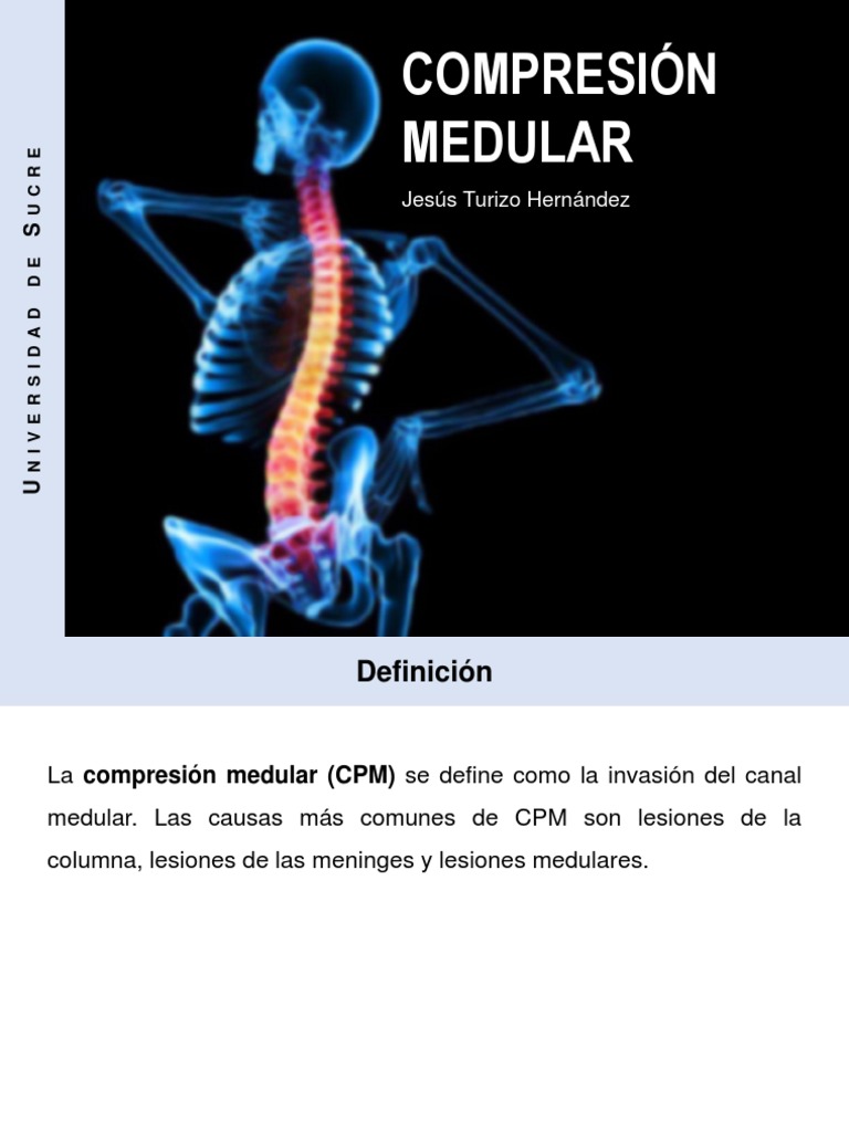 Compresión Medular | PDF