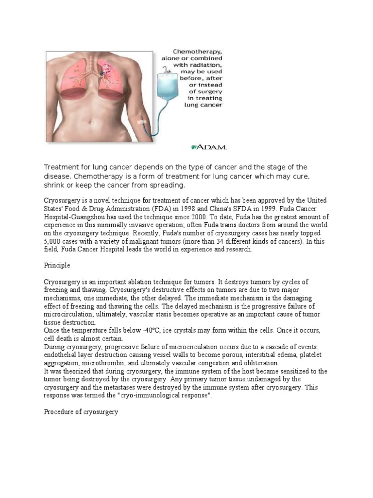Cryosurgery for Lung Cancer Treatment | PDF | Self-Improvement