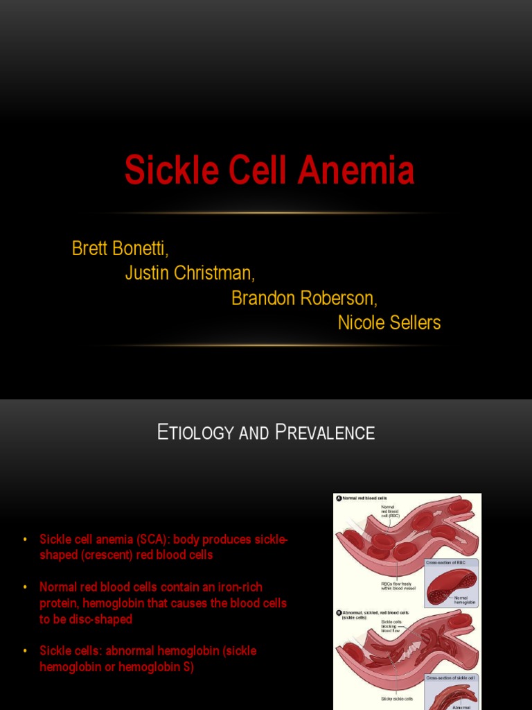 Sickle Cell Anemia Powerpoint | PDF | Sickle Cell Disease | Stroke