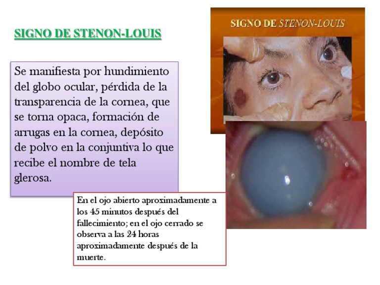 SIGNO DE STENON-LOUIS.pptx | Sistema visual | Anatomía humana