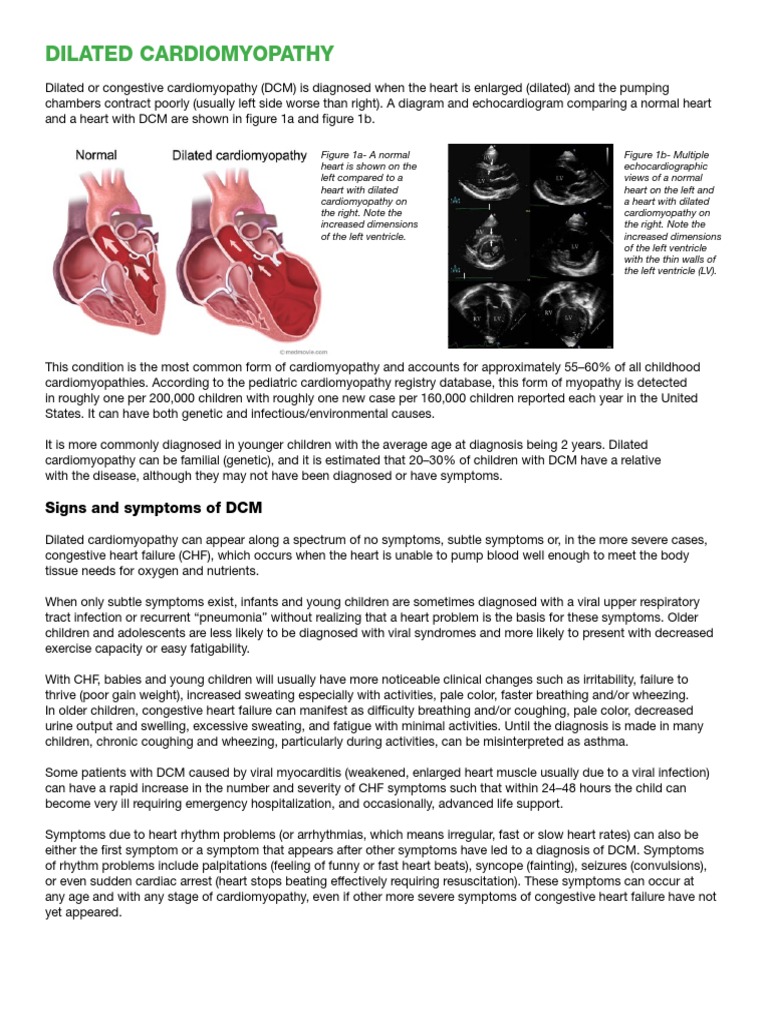 Dilated Cardiomyopathy PDF | Artificial Cardiac Pacemaker | Heart Failure