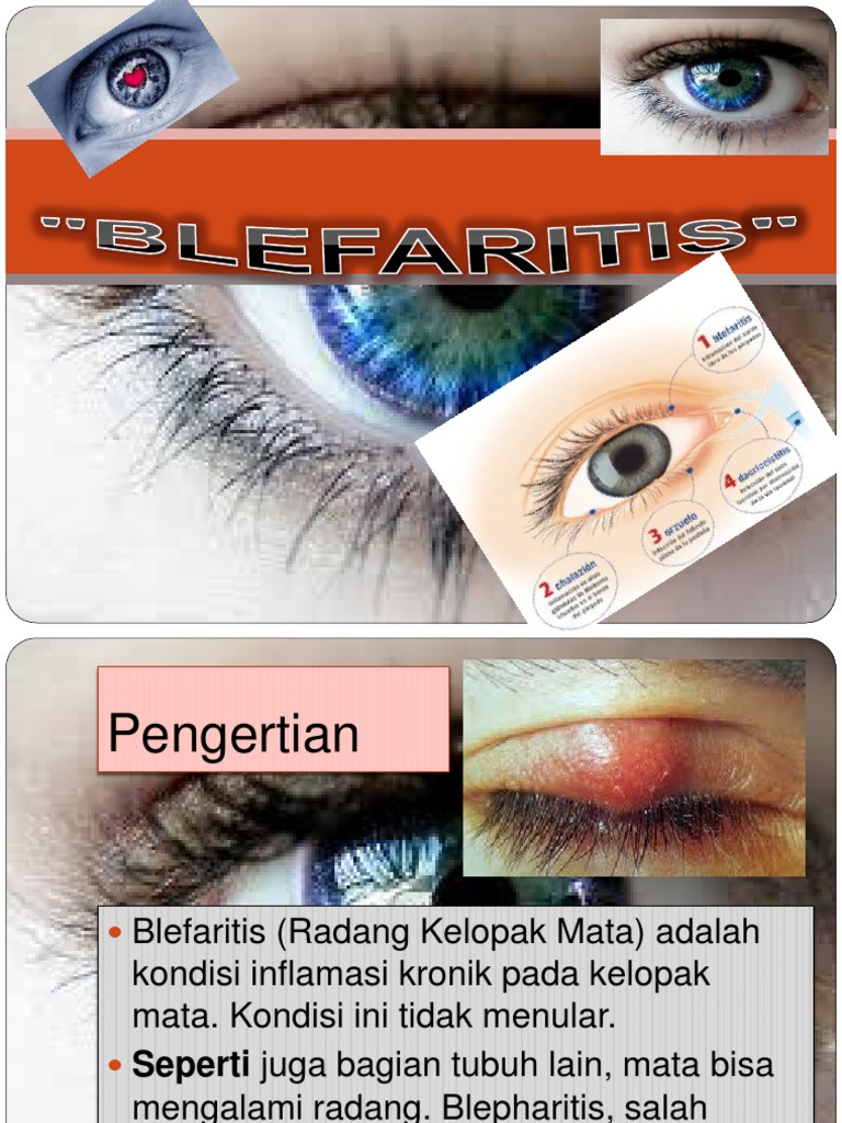 Blefaritis Dan Hordeolum | PDF