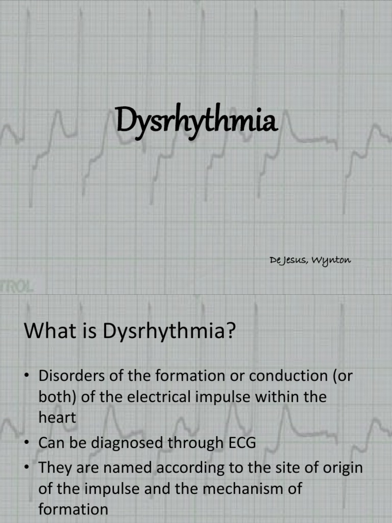 Dysrhythmia Powerpoint | PDF | Atrium (Heart) | Heart