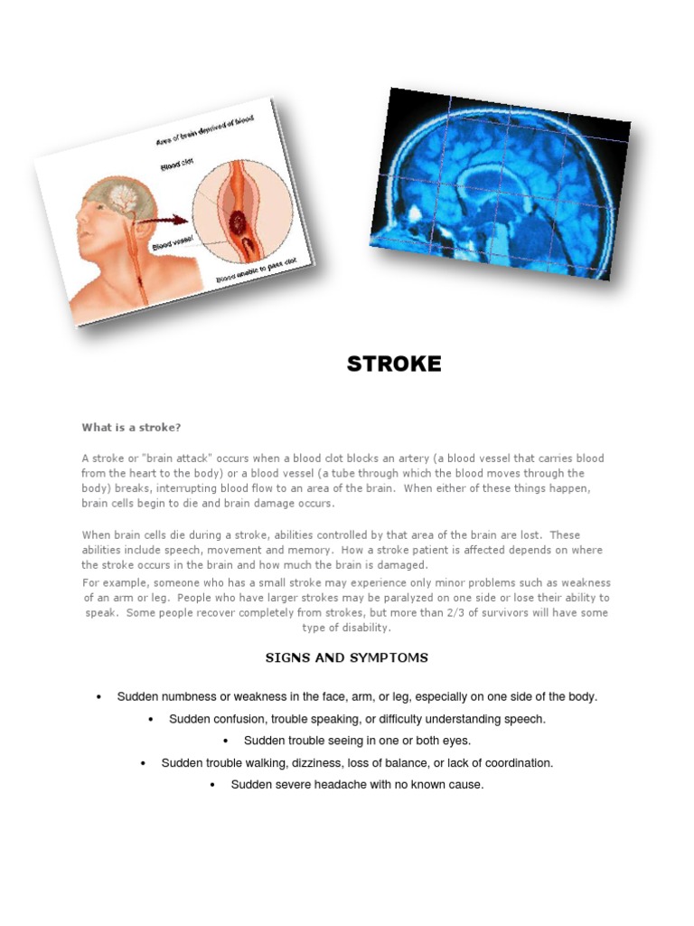 Understanding Strokes: Causes, Symptoms, Treatments and Prevention | PDF | Stroke | Clinical ...