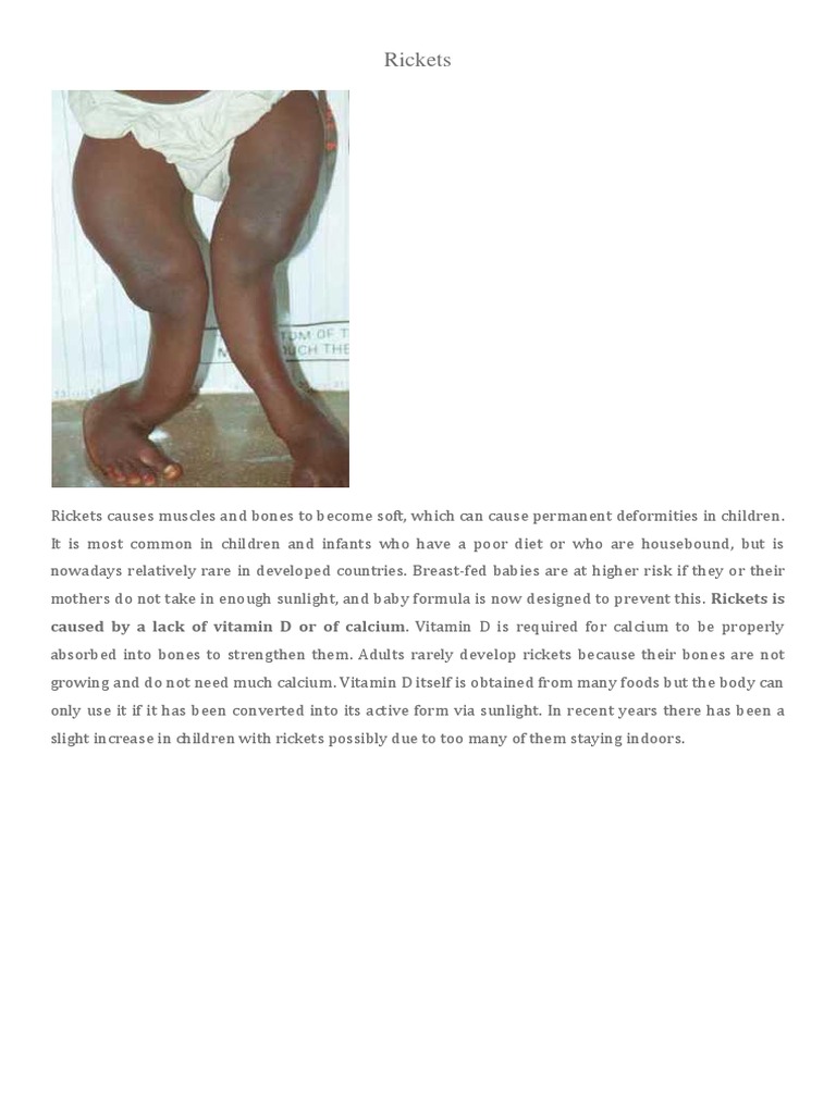 Rickets: Caused by A Lack of Vitamin D or of Calcium. Vitamin D Is ...