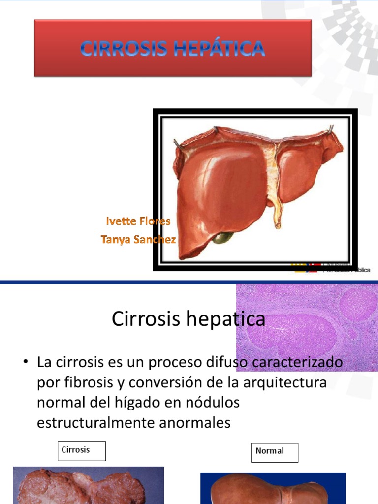 Cirrosis Hepatica | Cirrosis | Hepatitis
