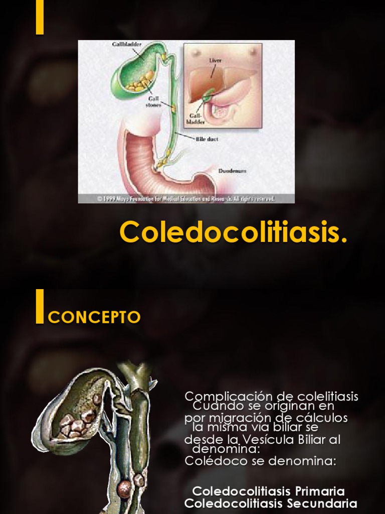 Diagnóstico y Tratamiento de Coledocolitiasis | PDF | Enfermedades ...