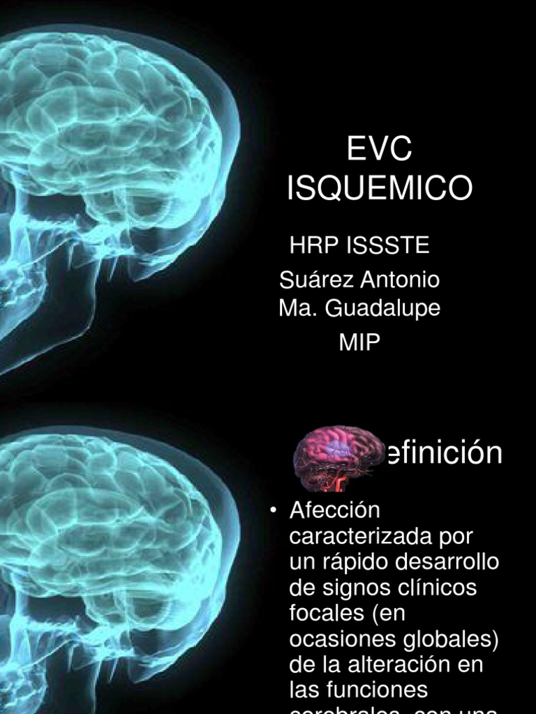 Evc Isquemico | PDF | Infarto de miocardio | Carrera