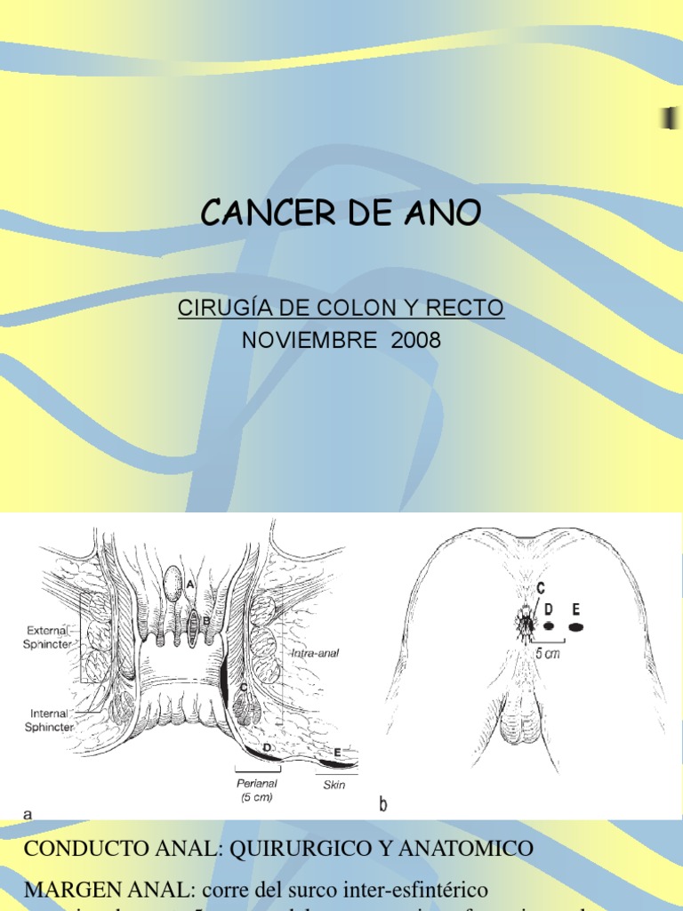 Cancer de Ano. | PDF | Metástasis | Sarcoma