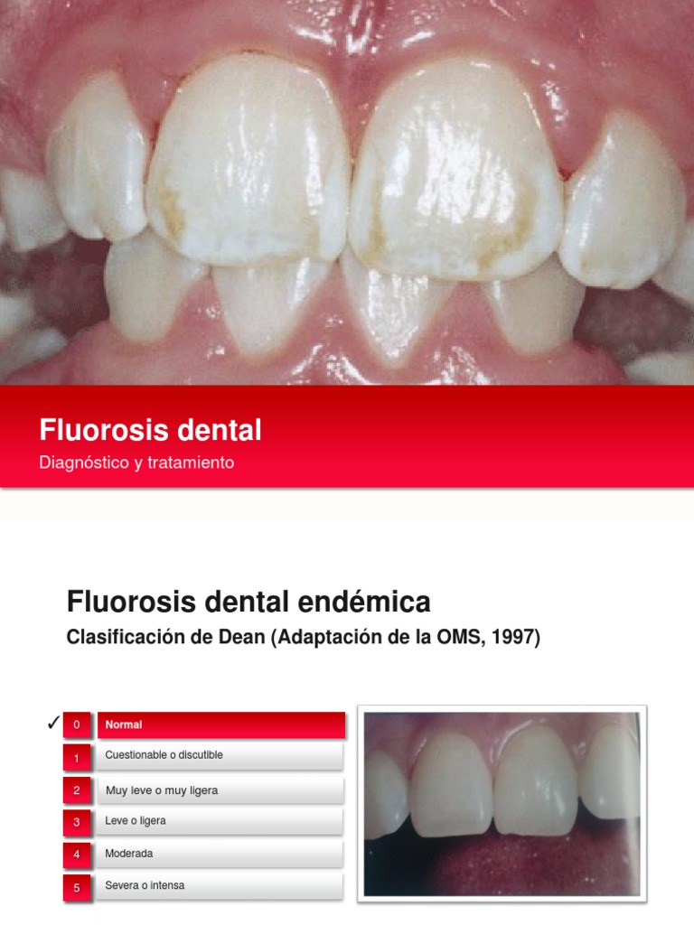 Fluorosis Dental
