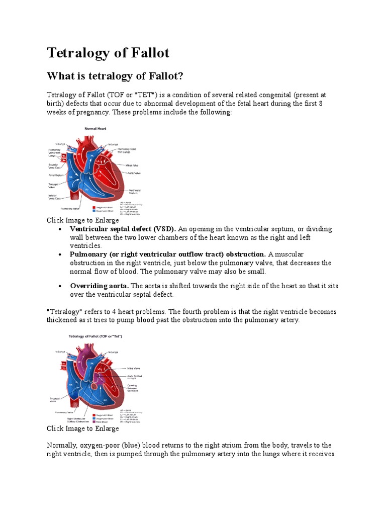 Tetralogy of Fallot | PDF | Congenital Heart Defect | Ventricle (Heart)