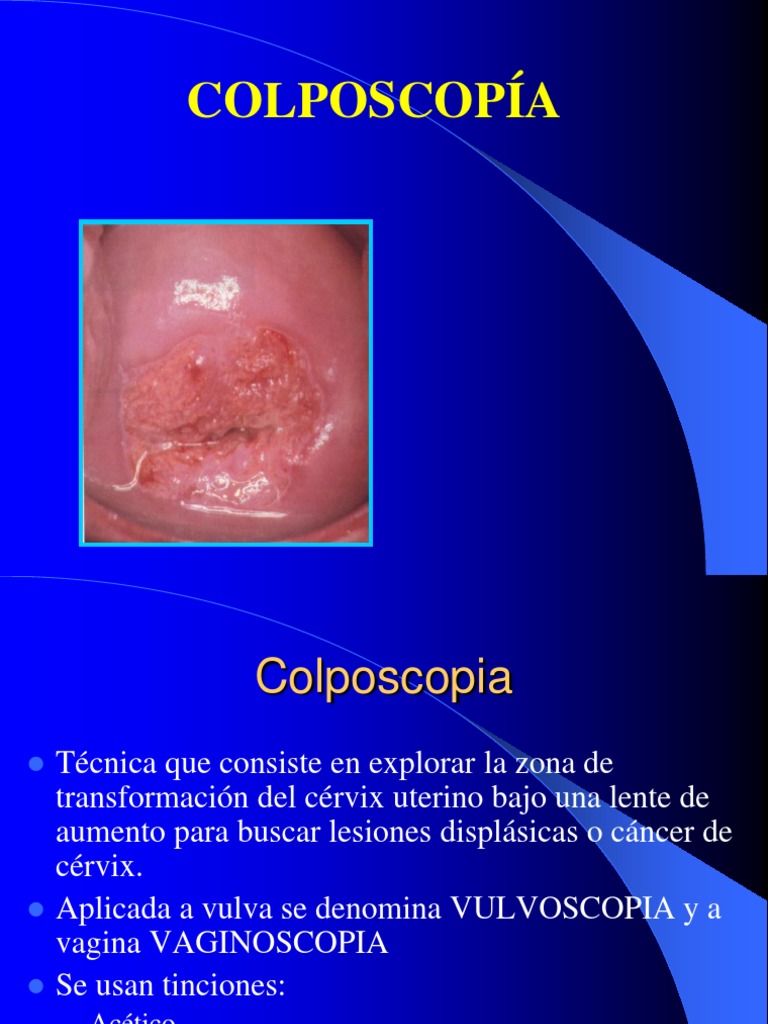 Colposcopia Basica | PDF | Medicina | Enfermedades y trastornos Colposcopia Basica | PDF | Medicina | Enfermedades y trastornos