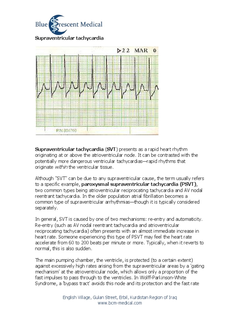 Paroxysmal Supraventricular Tachycardia (psvt)