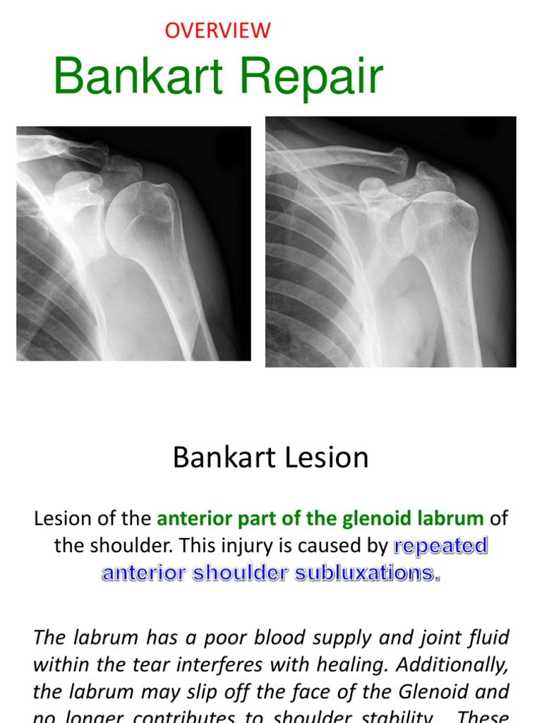 Bankart Lesion