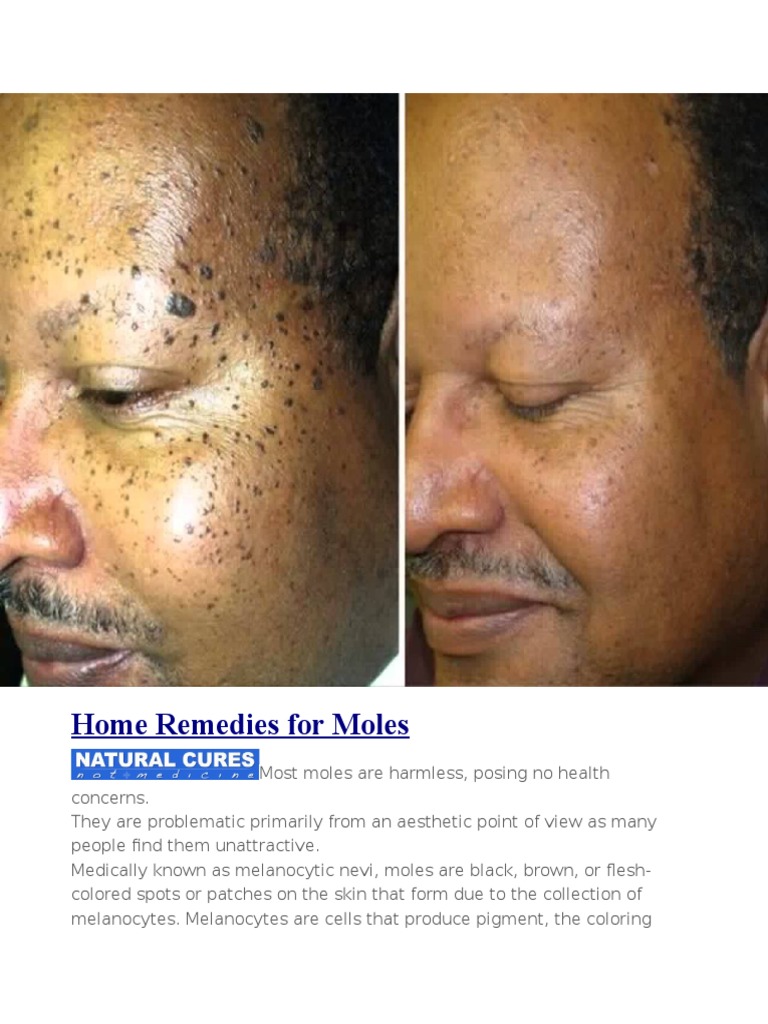 Apple Cider Vinegar for Mole Removal | PDF | Vinegar | Nature