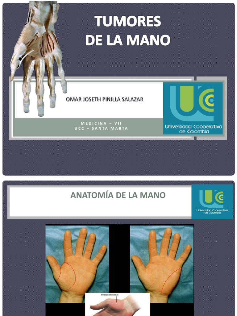 Tumores de la Mano: Tipos y Tratamientos | PDF | Mano | Neoplasias