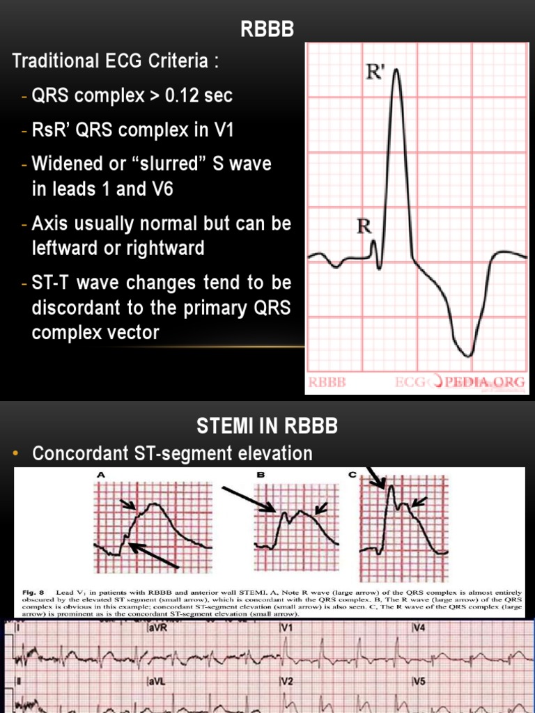 STEMI RBBB Type | PDF