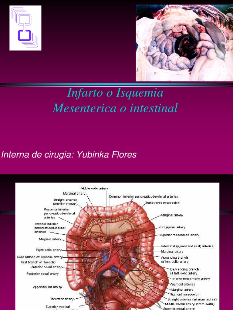 isquemia-intestinal (1).ppt | Isquemia | Infarto de miocardio
