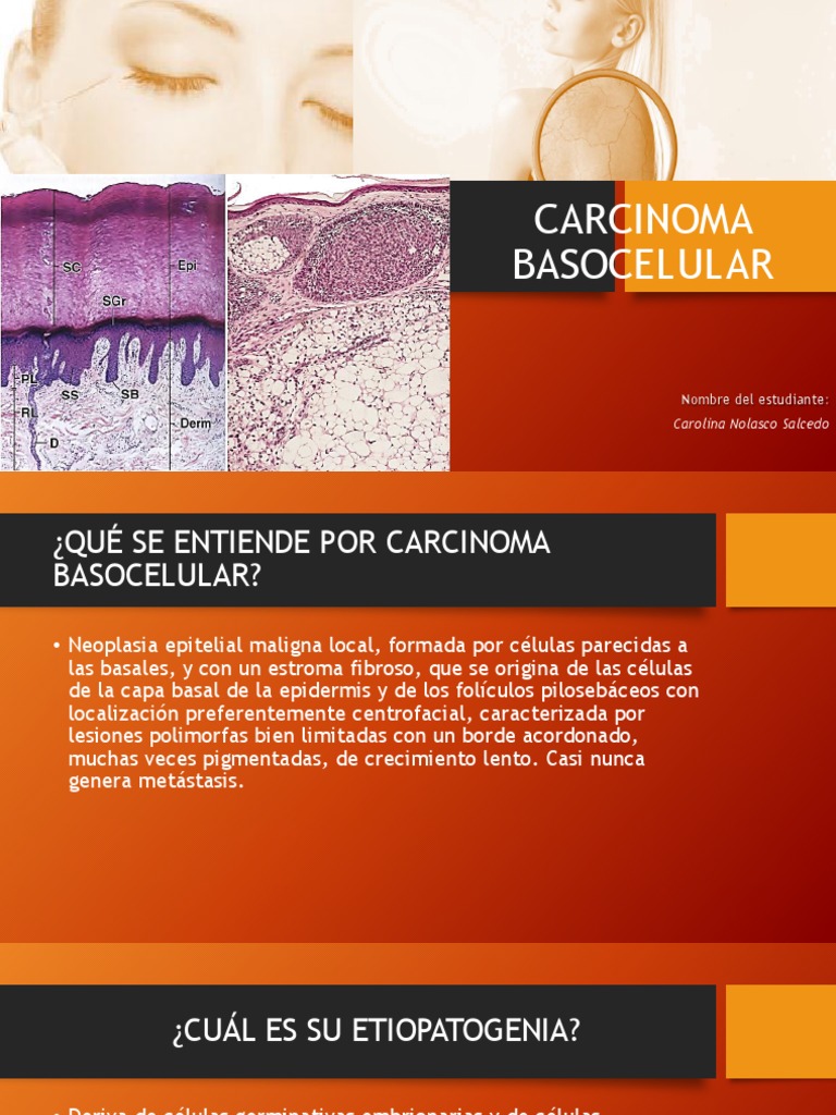 Carcinoma Basocelular: Tipos y Síntomas | PDF | Epidermis | Cáncer