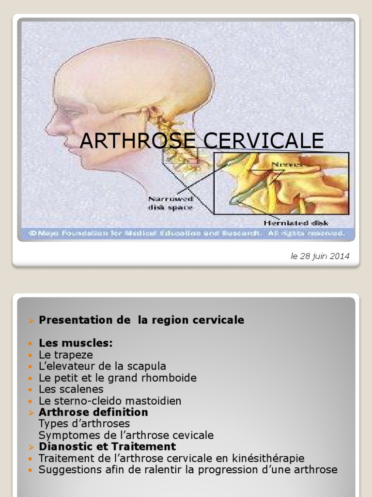 Traitement de l'Arthrose Cervicale | PDF | Arthrose | Cou