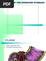 Stamm Gastrostomy Procedure Steps | PDF | Surgical Suture | Medicine
