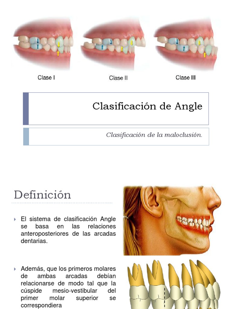 Clasificación de Angle | PDF