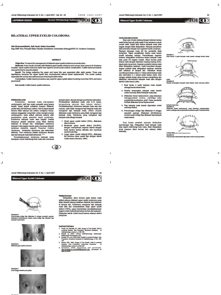 Bilateral Upper Eyelid Coloboma PDF | PDF