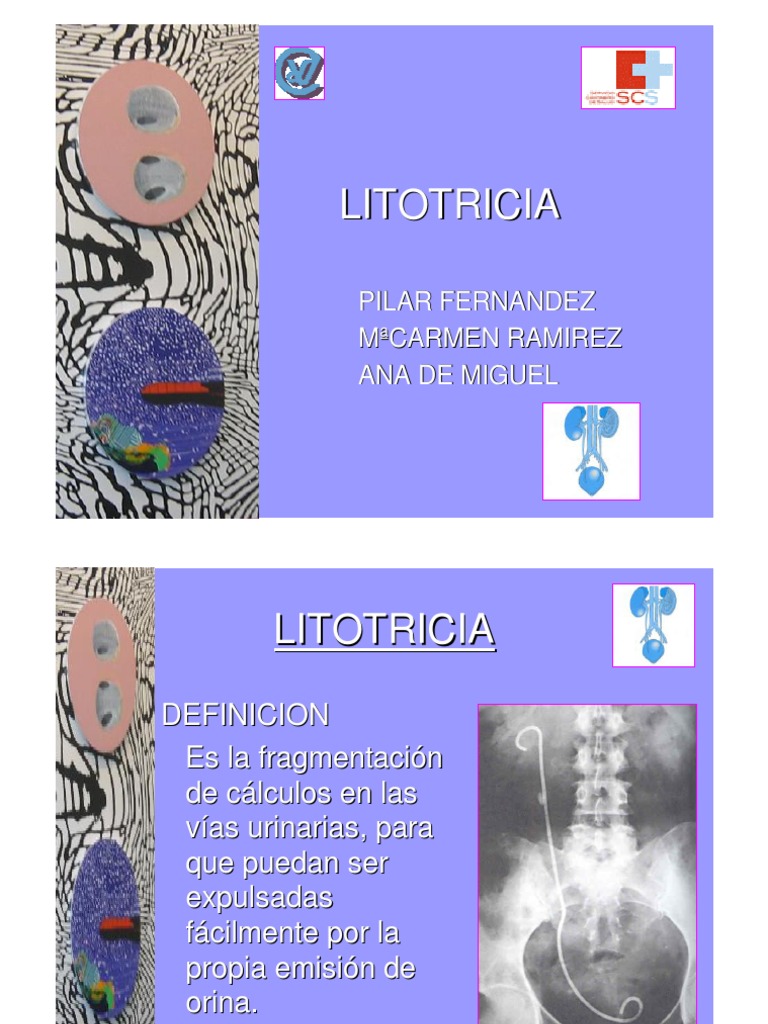 Litotricia: Guía Completa del Procedimiento | PDF | Especialidades ...