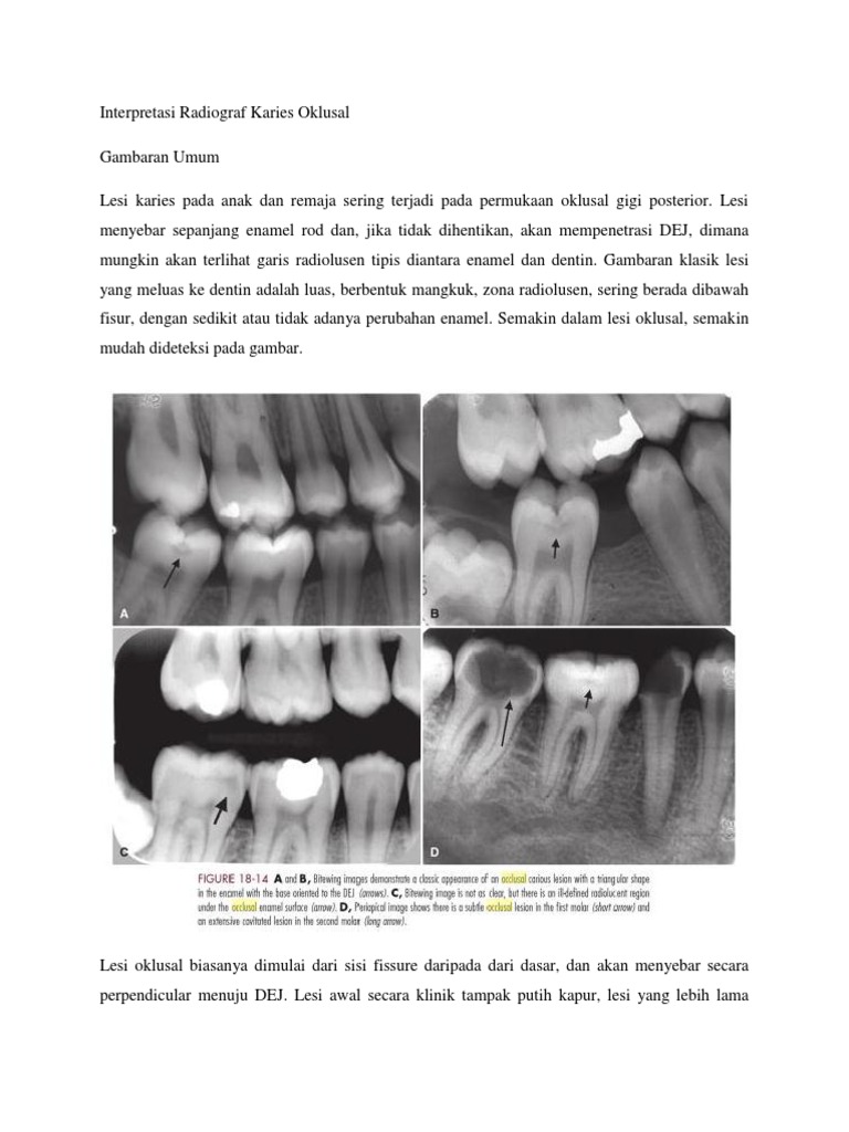 Interpretasi Radiograf Karies Oklusal | PDF