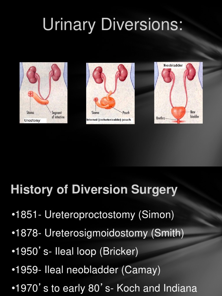 Neo Bladder | Urinary Incontinence | Surgical Specialties