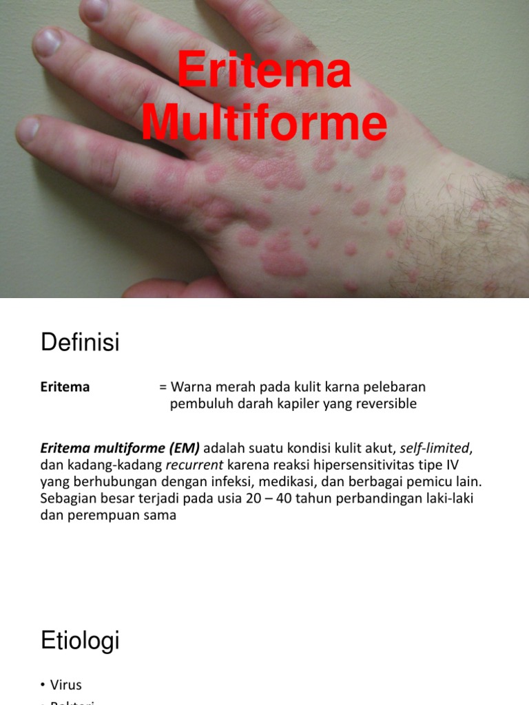 Eritema Multiforme | PDF