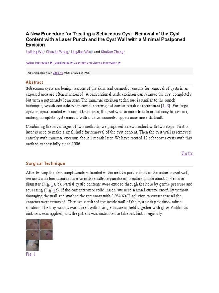 New Minimal Excision for Sebaceous Cysts | PDF | Surgery | Scar
