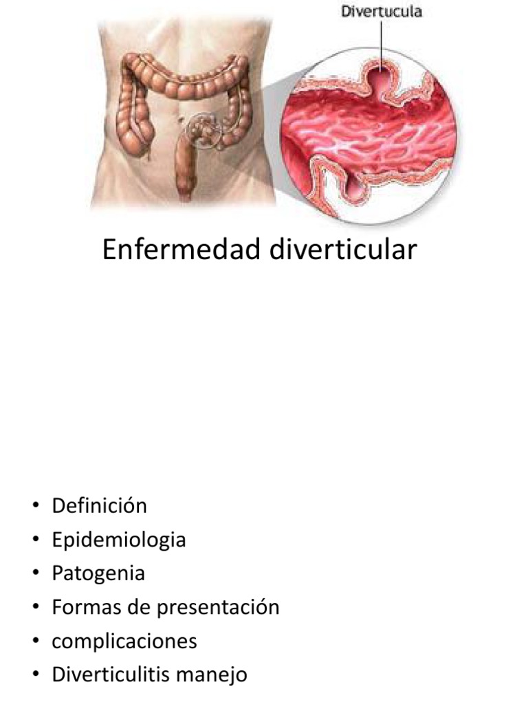 diverticular.pdf | Enfermedades y trastornos | Medicina CLINICA