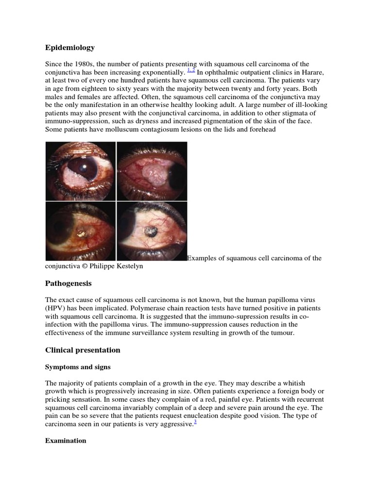 Data SCC From Internet | PDF | Immunodeficiency | Carcinoma