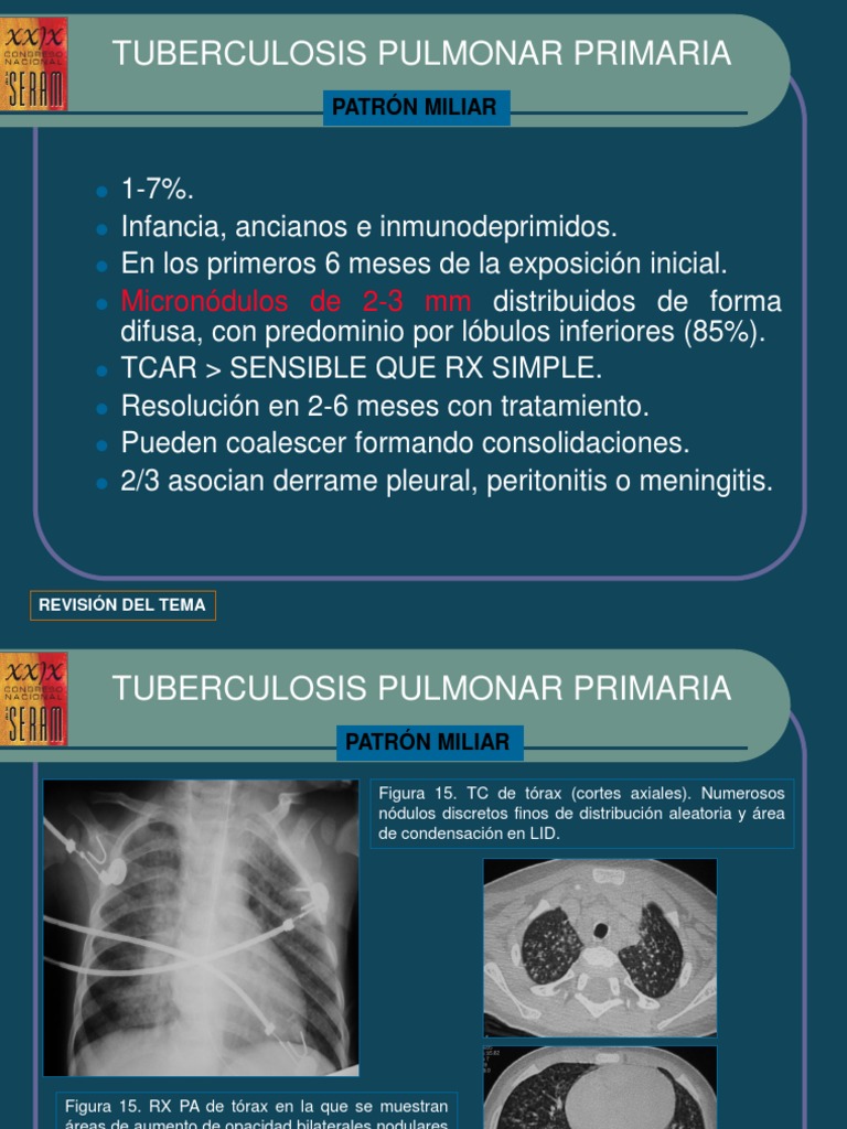 Poster TBC Adulto. Revisin Del Tema II | PDF | Pulmón | Tuberculosis