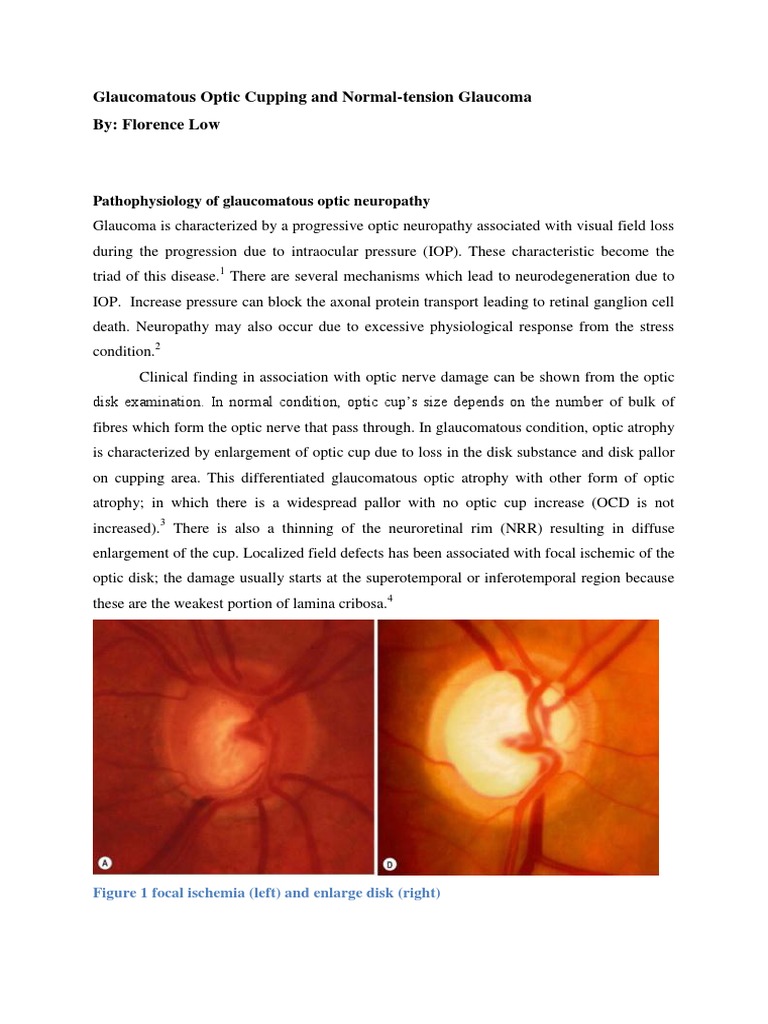 Glaucomatous Optic Cupping and Normal | PDF | Glaucoma | Diseases Of ...