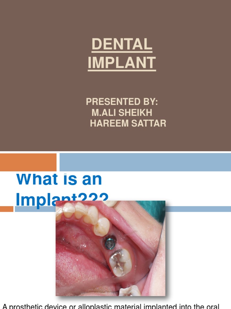 Dental Implant | PDF | Dental Implant | Human Tooth