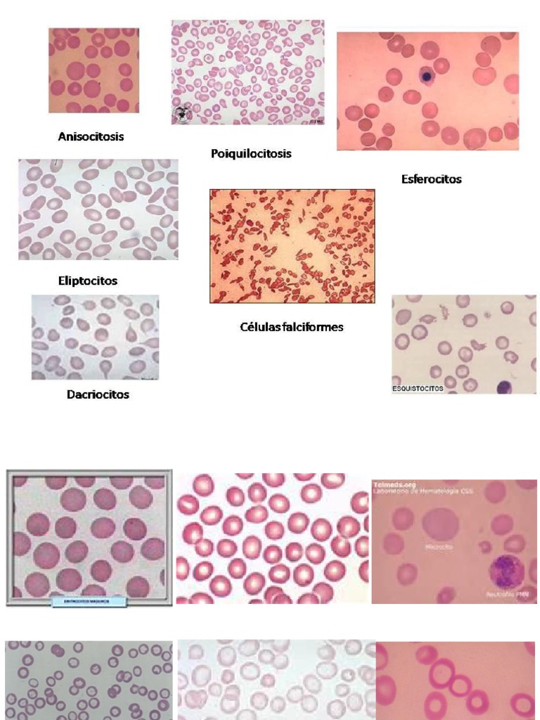 Anormalidades Eritrocitos.pptx | Glóbulo rojo | Anemia