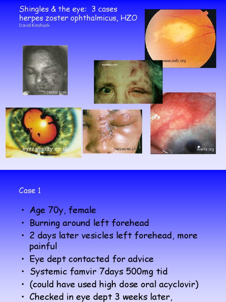 Zoster | PDF | Herpes Simplex | Epidemiology