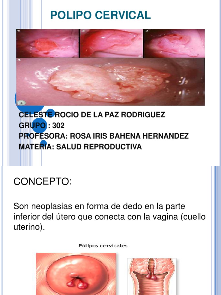 Pólipos Cervicales: Causas y Tratamiento | PDF | Vagina | Cáncer