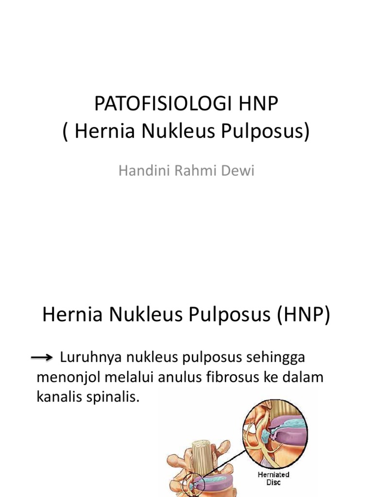 Patofisiologi HNP | PDF