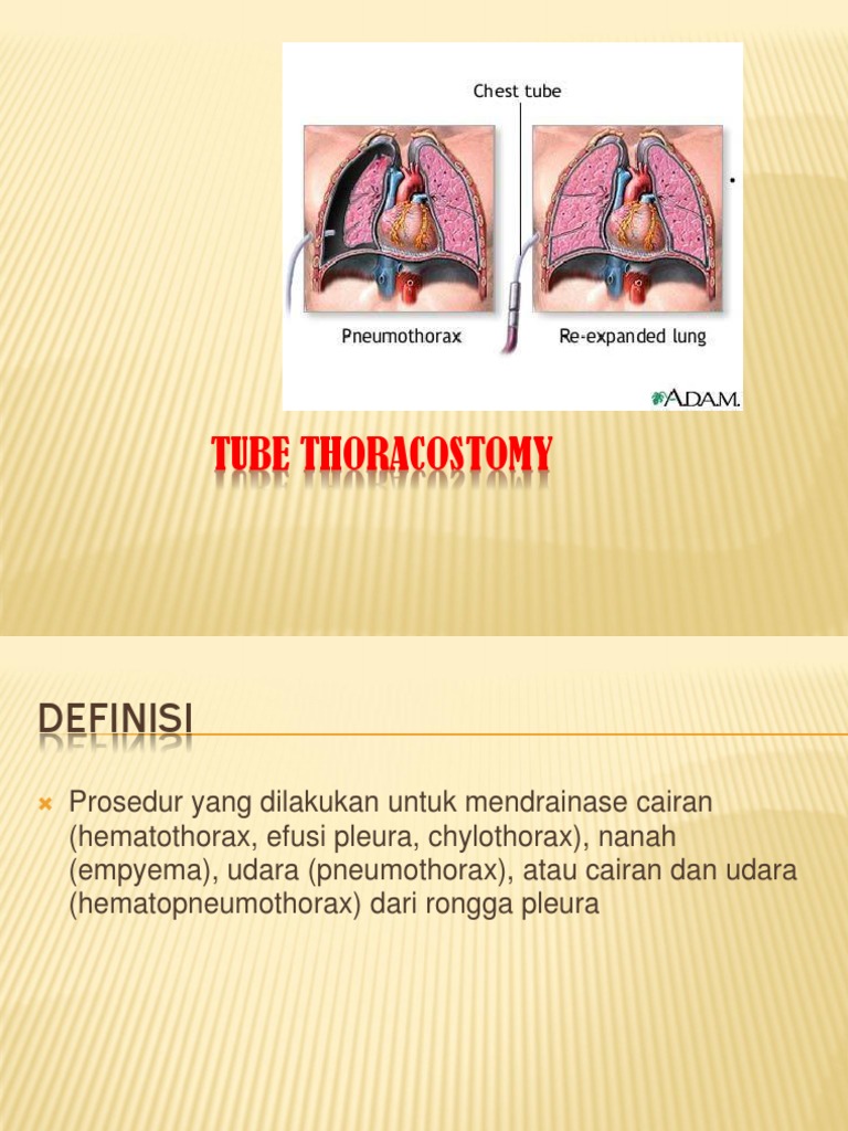 Pemasangan Chest Tube dan Indikasinya | PDF