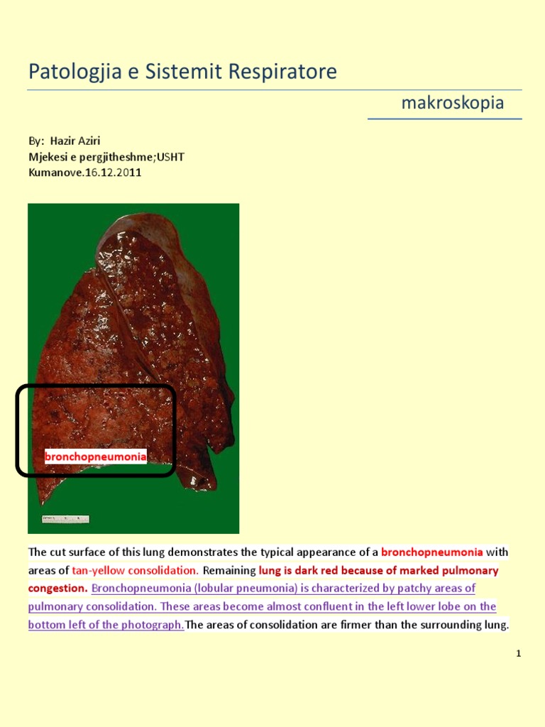 Mushkerite PDF | Lung | Metastasis