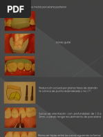 Líneas de Terminación | PDF | Dentadura postiza | Diente