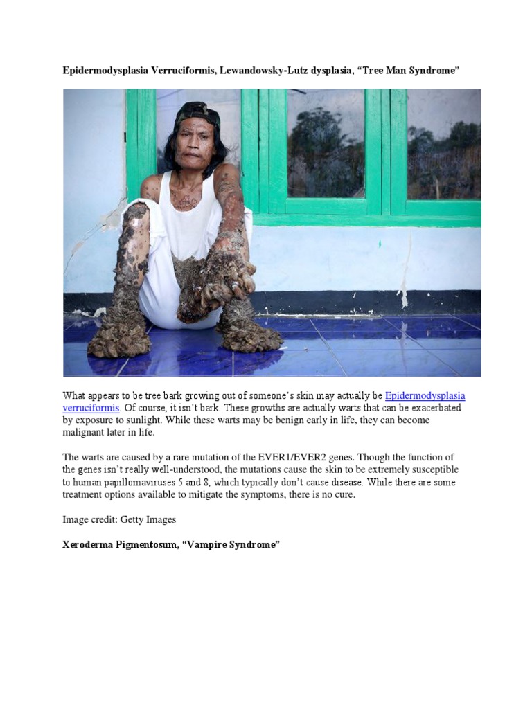 Tree Man Disease Cure