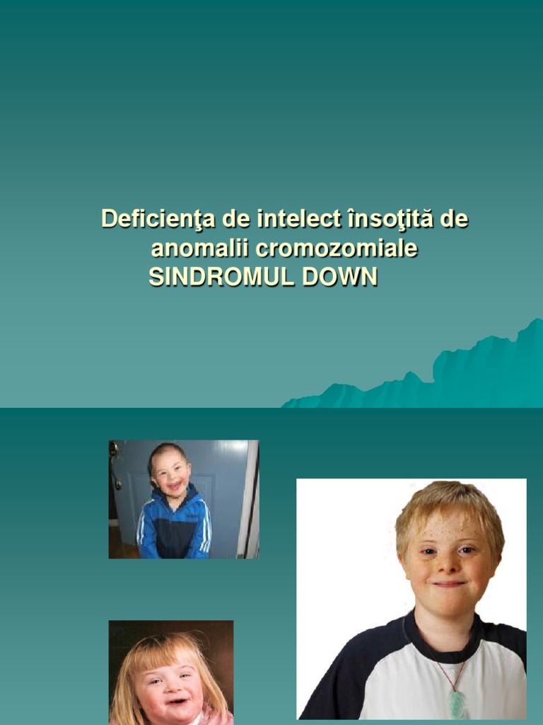Sindrom Down | PDF